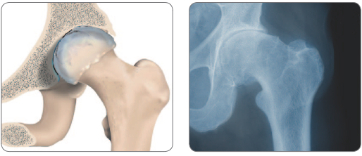 Coxarthrose – Dr. med. Mathias Bieberbach